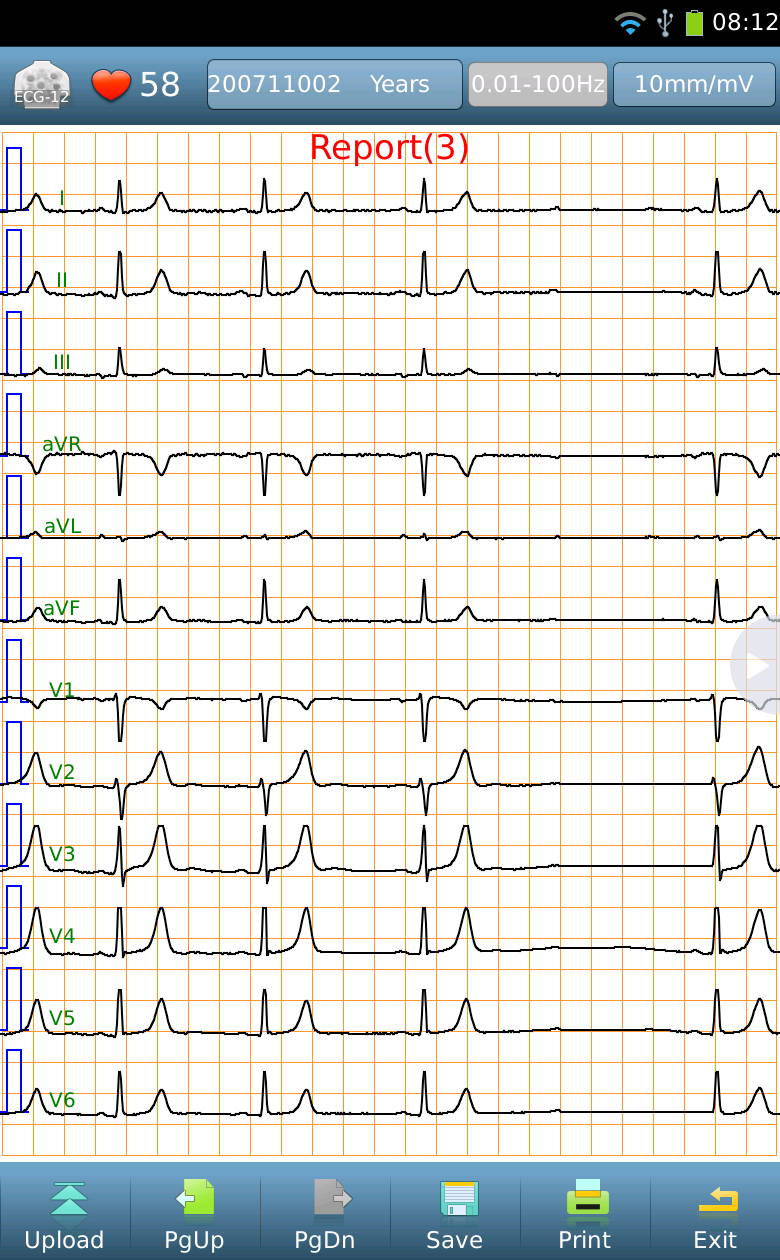Point-of-Care 12-Lead ECG/EKG Machine Based on A Tablet, with Auto Interpretation & Analysis ...